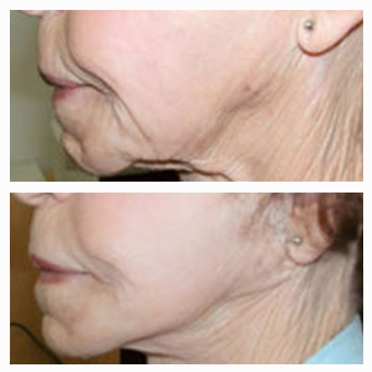 Best Thread Lift Melbourne | Cost Of Thread Lift | Facial Thread Lift ...